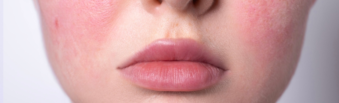 Protector solar para rosácea de Heliocare | Cantabria Labs España