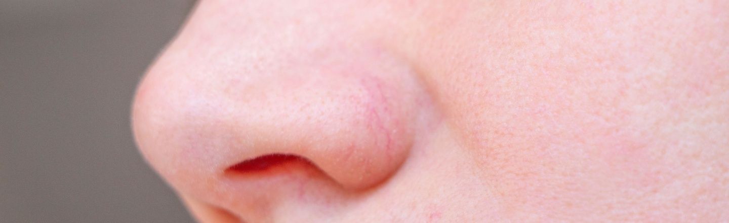 ¿Qué es la cuperosis? Síntomas y tratamiento | Cantabria Labs España