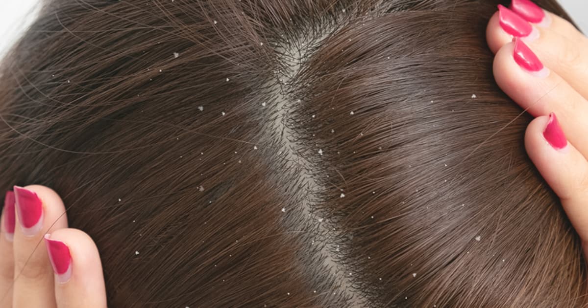 Grandes Flocos De Caspa Caspa Pode Causar A Queda De Cabelo? Blog